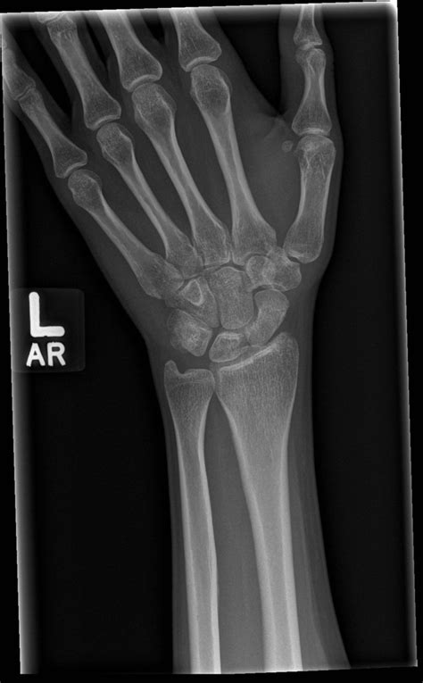 Scaphoid Fracture Avascular Necrosis Scaphoid Fracture Avascular Necrosis