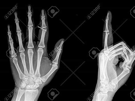 ¿cómo Saber Si Tengo Una Fractura En El Dedo De La Mano