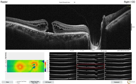 Oct In The Diagnosis Of Vitreomacular Disease Woo University