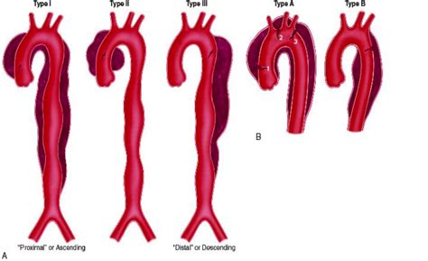 Aortic Dissections Diagram Quizlet