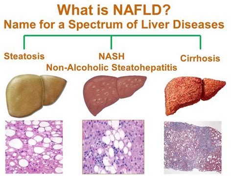 Nonalcoholic Steatohepatitis Causes Symptoms Diagnosis Treatment