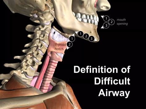 Asa Guidelines For Management Of The Difficult Airway Pptx