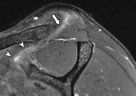 Imaging Of The Acromioclavicular Joint Anatomy Function Pathologic Features And