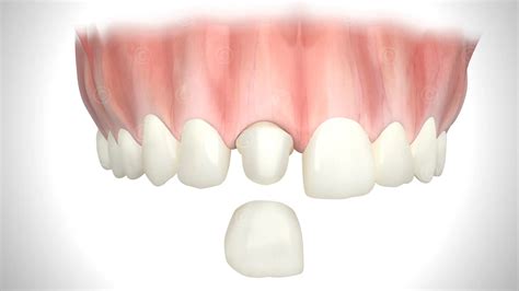 3d Animation Dental Crown Video Medicalgraphics