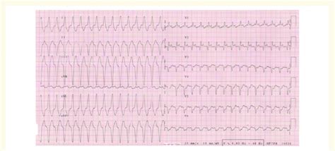 Ventricular Tachycardia From Apical Node Download Scientific Diagram