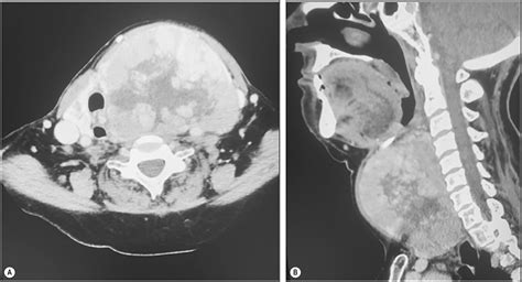 Thyroid And Parathyroid Glands Clinical Tree
