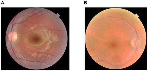 Frontiers Smart Grading Of Diabetic Retinopathy An Intelligent Recommendation Based Fine