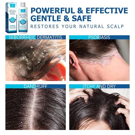Psoriasis Shampoo Seborrheic Dermatitis Shampoo