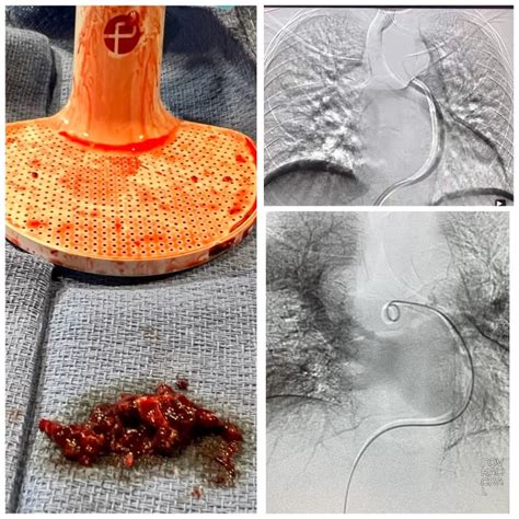 Video Jose Hernandez On Linkedin Pe Thrombectomy With Lightning 12