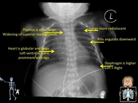 What Is A Thymic Shadow At Rosalie Kirby Blog