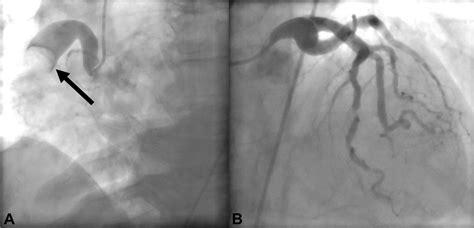 A Angiogram Showed A Large Luminal Filling Defect In The Proximal Download Scientific Diagram