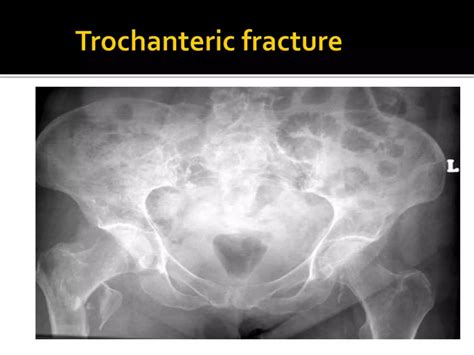 Hip Jointppt Hip Jointppt