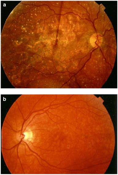 Basal Laminar Drusen And Atrophic Maculopathy In Patient 2 In 2003 B Download Scientific