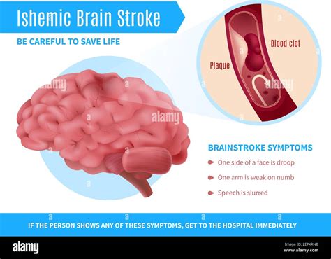 Ischemic Brain Stroke Realistic Poster With Symptoms List And Call To