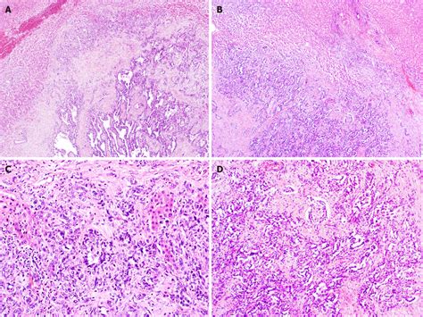 Hepatic Angiosarcoma A Unencapsulated Vascular Lesion B