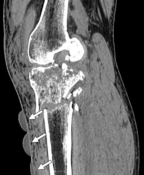 Three Column Classification System For Tibial Plateau Fractures What