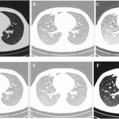 Block Diagram For Proposed Method Of Lung Nodule Image Segmentation