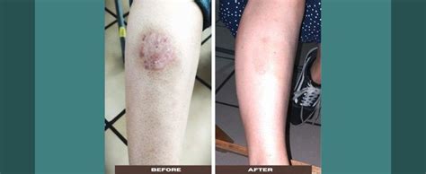 Manish Bhatia On Linkedin Psoriasis Vulgaris Treated With Classical