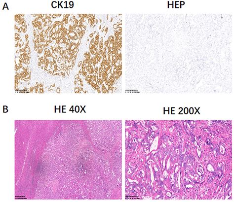 Fgfr2 Bicc1 A Subtype Of Fgfr2 Oncogenic Fusion Variant In Cholangioc