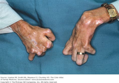 Scleroderma And Morphea Basicmedical Key