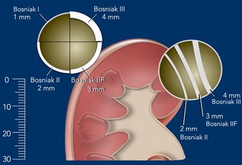 Bosniak Radiopaedia Renal Cyst Simple Or Complex Nephropocus