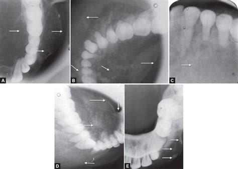 Peripheral Ossifying Fibroma Radiograph