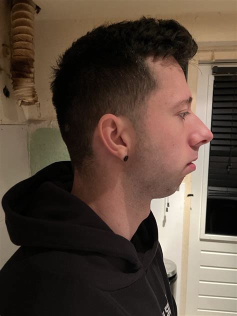 Update Djs Genio 3 Months Later 2 Surgeries Rjawsurgery