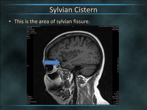 Ppt Brain Cisterns Powerpoint Presentation Free Download Id 2263744