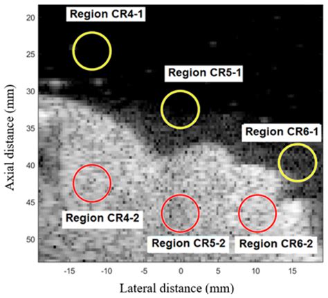 Improving Ultrasound B Mode Image Quality With Coherent Plane Wave Compounding Using Adaptive