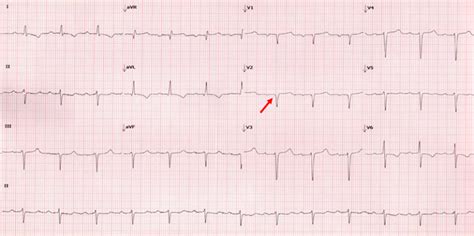 Amyloid Heart Disease Module 1 Diagnosis