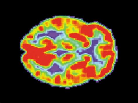SMSNA Study Examines Brain Activity Of Sex Addicts