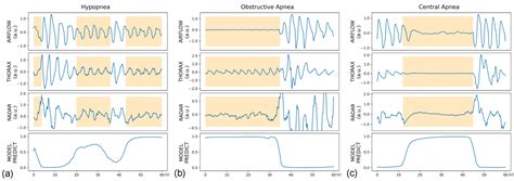 Sensors Free Full Text Automated Detection Of Sleep Apnea Hypopnea Events Based On 60 Ghz