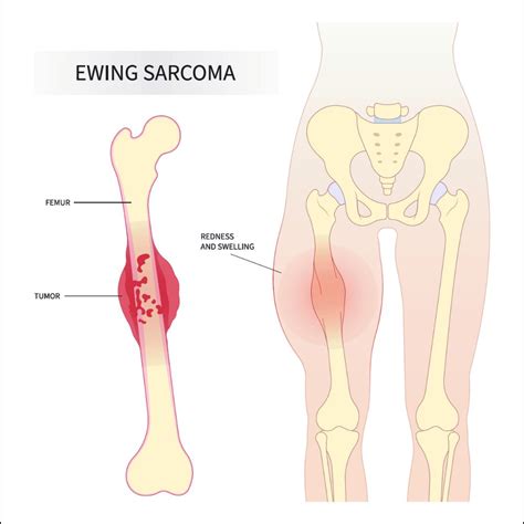 Imágenes Del Sarcoma De Ewing
