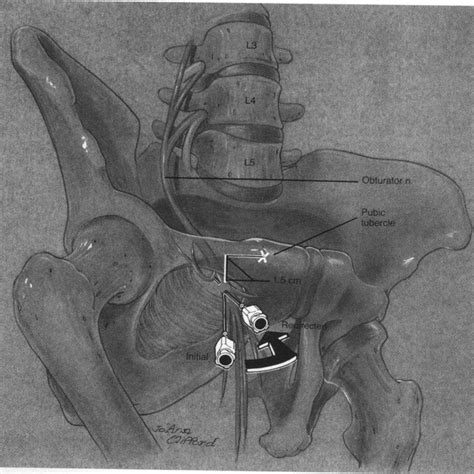 sciatic nerve block classic technique and positioning reprinted with