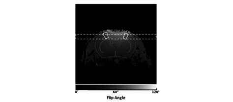 Radiofrequency RF Pulse Angle Map In Axial View At The Level Of The Download Scientific