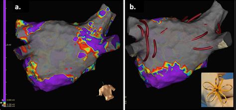 A Three Dimensional Electroanatomic Voltage Map Of The La Download