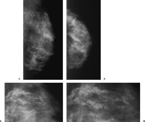 Calcifications Amorphousindistinct Microcalcifications Radiology Key