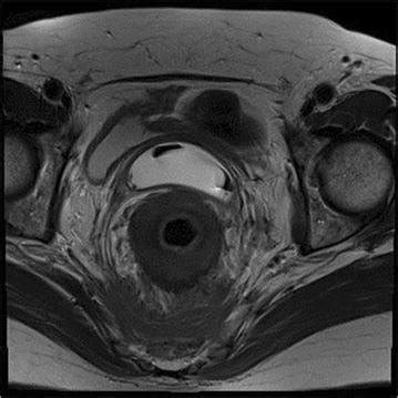 MRI Shows Diffuse Wall Thickening Of The Rectum And Infiltration Of The Download Scientific