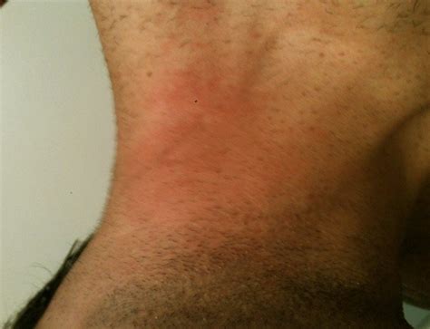 Itchy Neck Pictures Symptoms Treatment Rash Causes December