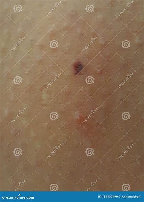 Assassin Bug Bite Mark From Fang Stock Image Image Of Bite Assasin