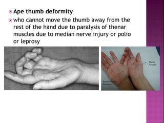 Ape Thumb Deformity To Publish Ppt