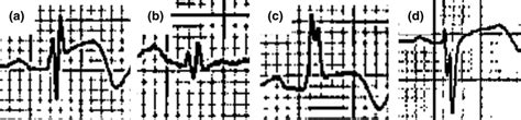 Fragmented Qrs Complex In Various Patterns A Rsr′ B Rsr′ C