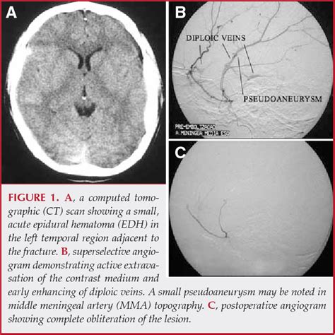 Acute Epidural Hematoma