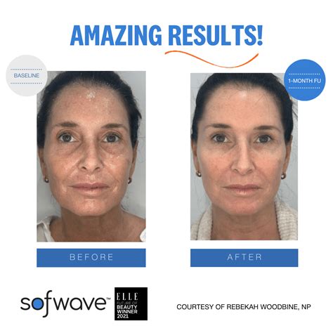 Sofwave Skin Tightening With Eyes San Jose Ca San Jose Medical Spa Medical Spa