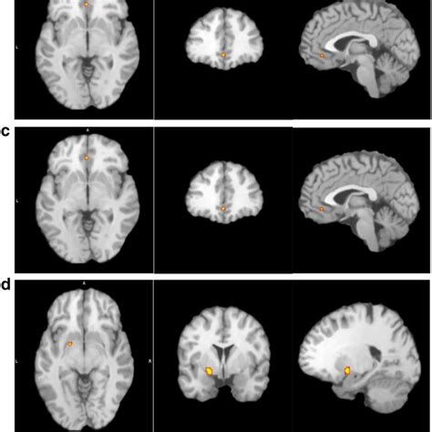 Results From Pairwise Activation Likelihood Estimation Analysis Each Download Scientific
