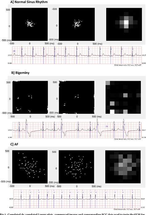 Figure 1 From Machine Learning Detection Of Atrial Fibrillation Using Wearable Technology