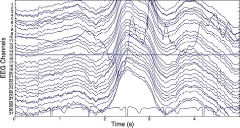 Figure 1 From An Efficient Epilepsy Prediction Model On European