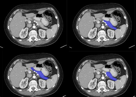How To Use The Staple Algorithm To Combine Multiple Image Segmentations