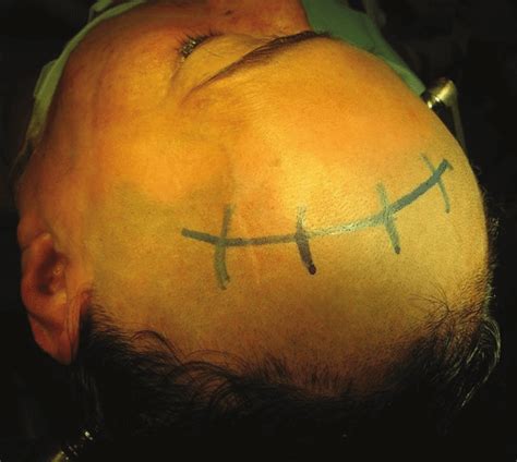 An 8 10 Cm Frontotemporal Skin Incision Is Outlined By A Surgical