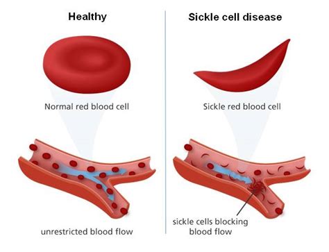 Sickle Cell Disease Essential Information For Africans